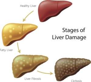 What is NAFLD? - Craft Body Scan